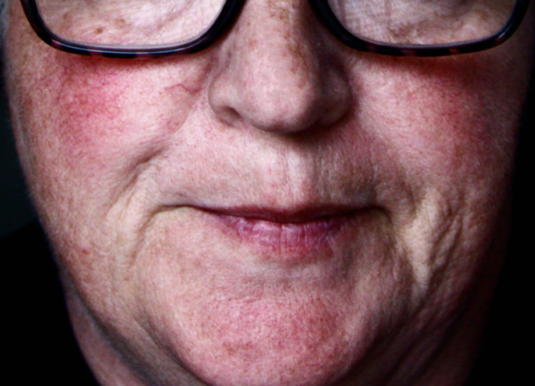 Seeing Red? What You Need to Know About Rosacea - Golden Gate ...